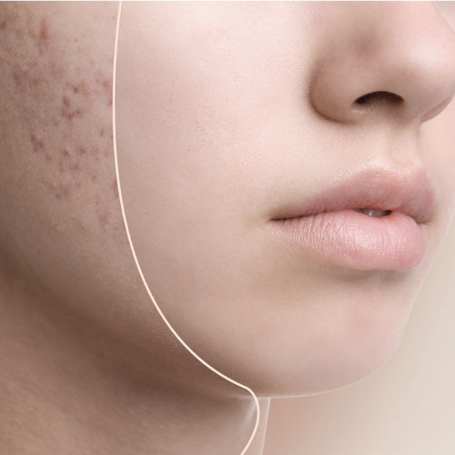 What are ‘Non-Comedogenic’ Skincare Products? - Farmherbs